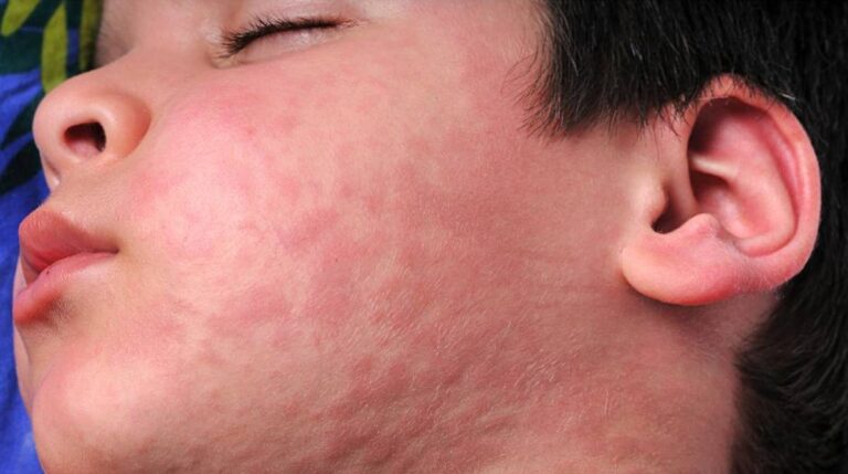 Penyakit Campak pada Anak, Kenali Cara Cegah dan 3 Fasenya